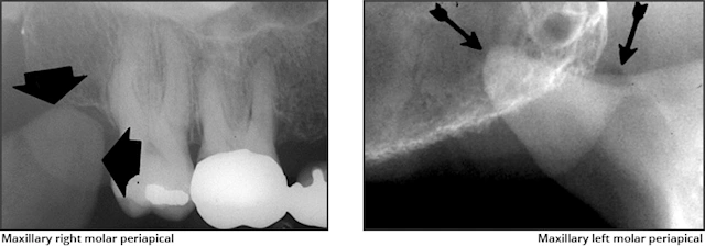 Maxillary Posterior Landmarks - Intraoral Radiographic Anatomy - Dentalcare