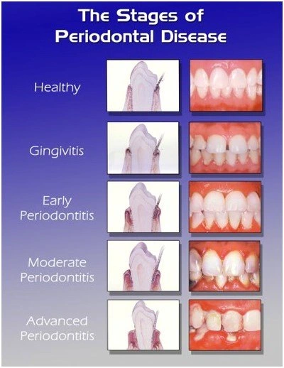 What is Gingivitis? | Dentalcare