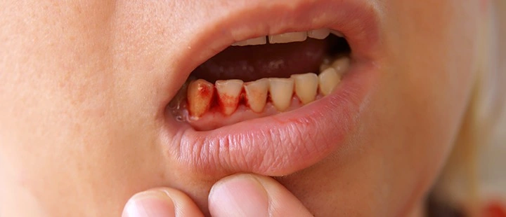 Bleeding Gums | Dentalcare