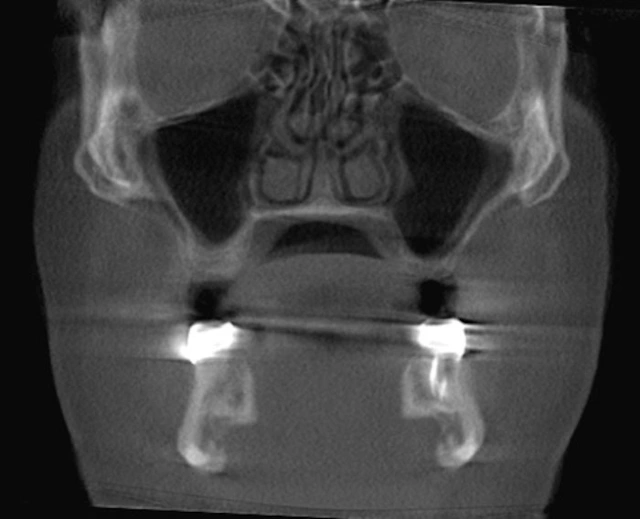 Image Artifacts - Cone-Beam Computed Tomography (CBCT) Applications in ...