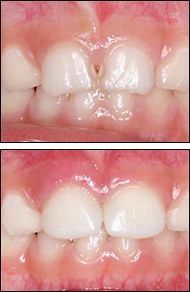 Full Coverage Aesthetic Restoration of Anterior Primary Teeth