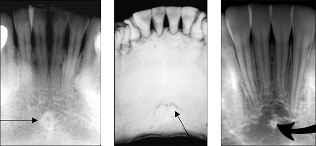 Mandibular Anterior Landmarks - Intraoral Radiographic Anatomy - Dentalcare