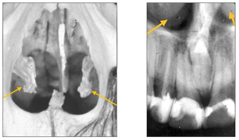 Maxillary Anterior Landmarks - Intraoral Radiographic Anatomy - Dentalcare