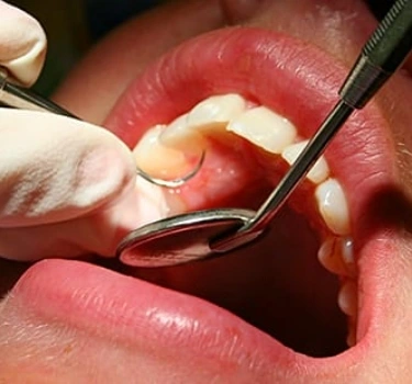 What is Plaque? | Dentalcare