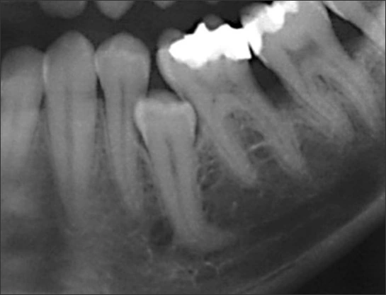 Delayed Eruption - Anomalies of Tooth Structure - Dentalcare