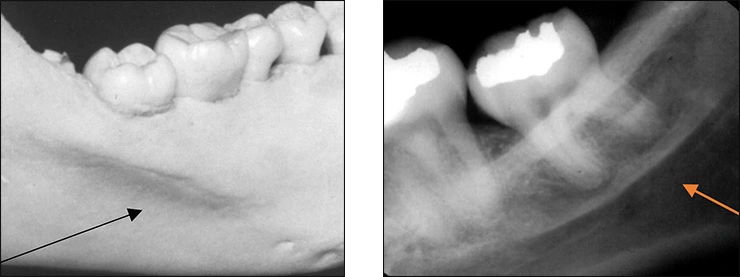 Mandibular Posterior Landmarks - Intraoral Radiographic Anatomy ...