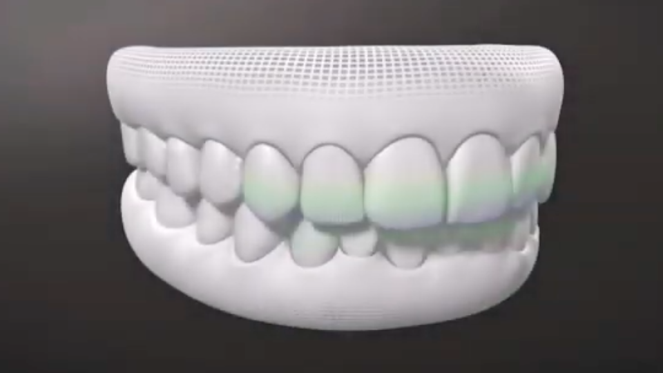 Invisalign - Invisalign G8