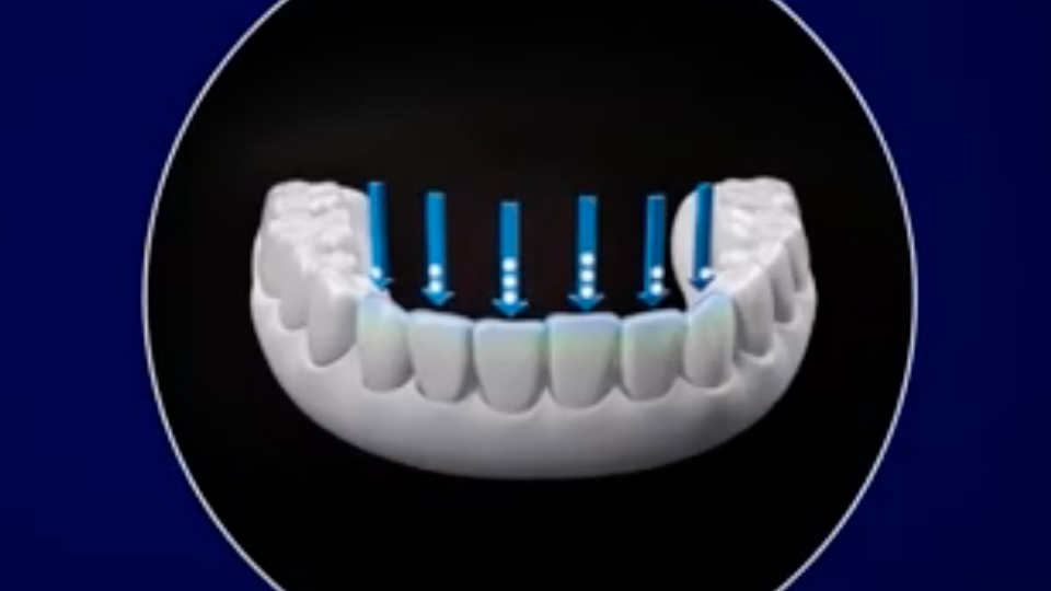 Invisalign - Invisalign G8