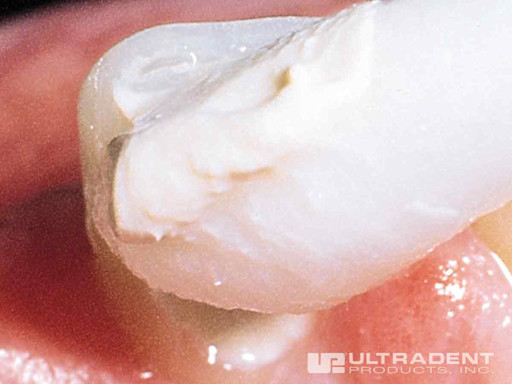 UltraTemp® - polikarboksylowy cement tymczasowy - Dornwell