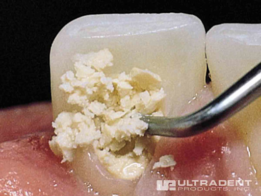 UltraTemp® - polikarboksylowy cement tymczasowy - Dornwell