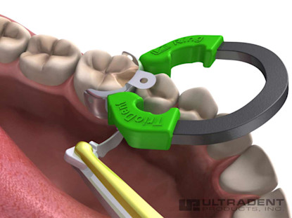 Triodent® V3 Ring - Products - Category - Ultradent Products, Inc.