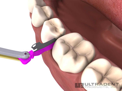 Triodent® V3 Ring - Products - Category - Ultradent Products, Inc.