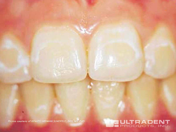Opalustre™ and OpalCups™-Chemical and Mechanical Abrasion Slurry