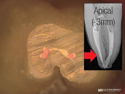 EndoREZ™ - Products - Category - Ultradent Products, Inc.