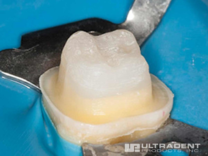 PermaFlo™ DC - Products - Category - Ultradent Products, Inc.