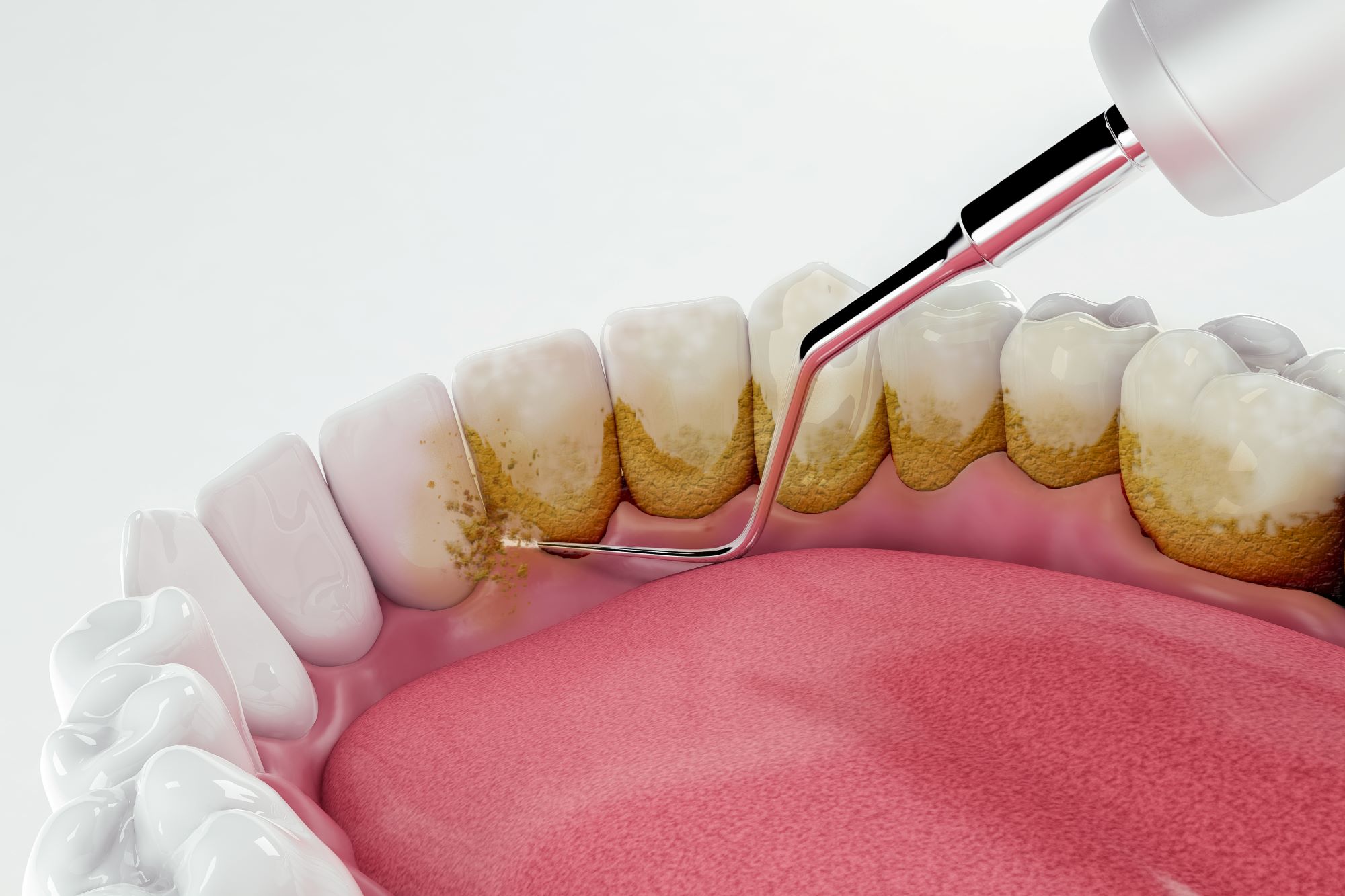 Zahnstein (oder Calculus dentis): Ursachen, Symptome und Entfernung ...