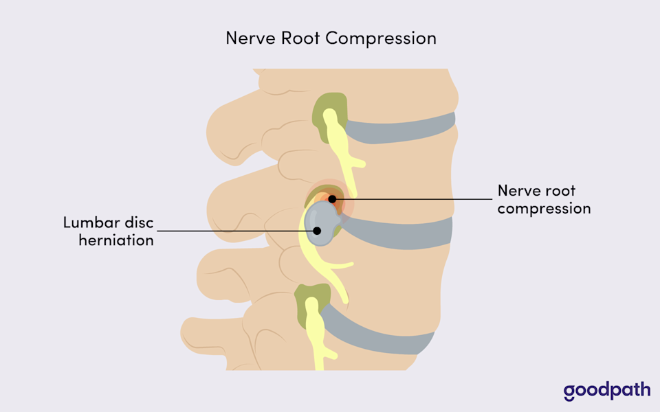 6 Proven Exercises for Reducing Sciatica Pain | Goodpath