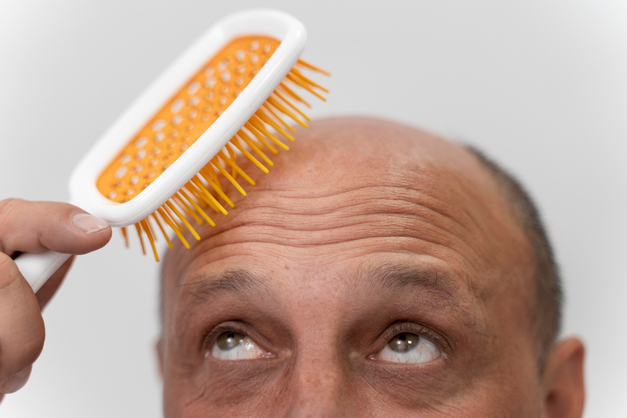 Exploring Spironolactone for Male Hair Loss: Off-Label Uses and ...
