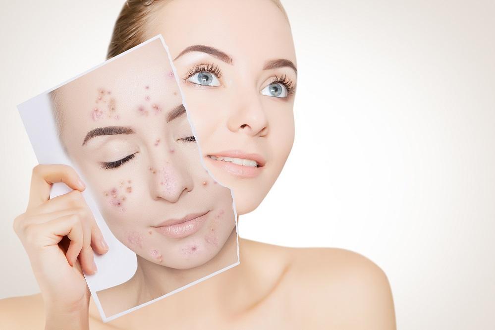 A Guide to Tretinoin: Understanding Its Benefits and Proper Usage ...
