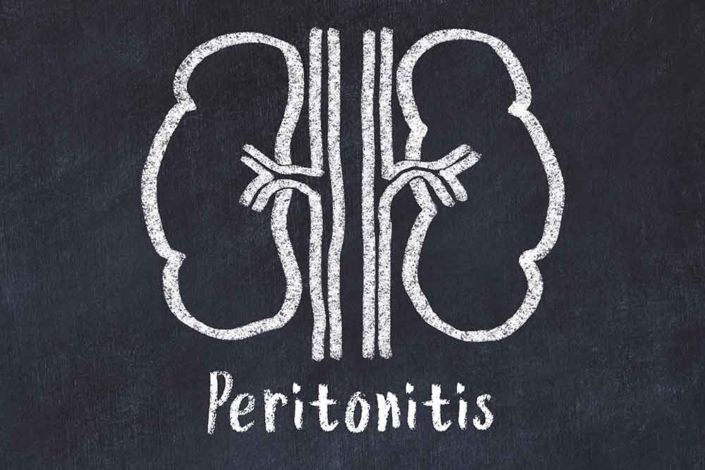What You Need to Know about Peritonitis Symptoms And Treatments | CareCard