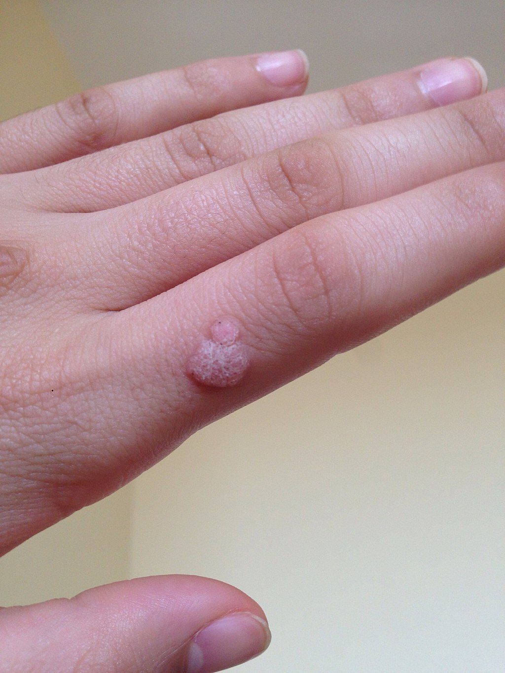 Flat Warts On Palm