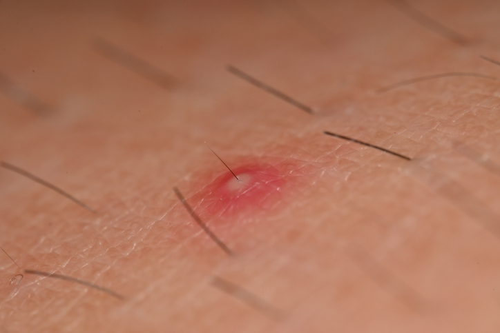 Infected Ingrown Hair On Neck