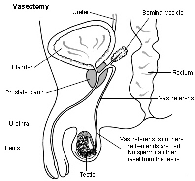 Vasectomy Cks