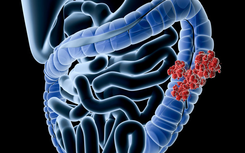 UPFs and early onset colon cancer: Key findings from a major new study ...