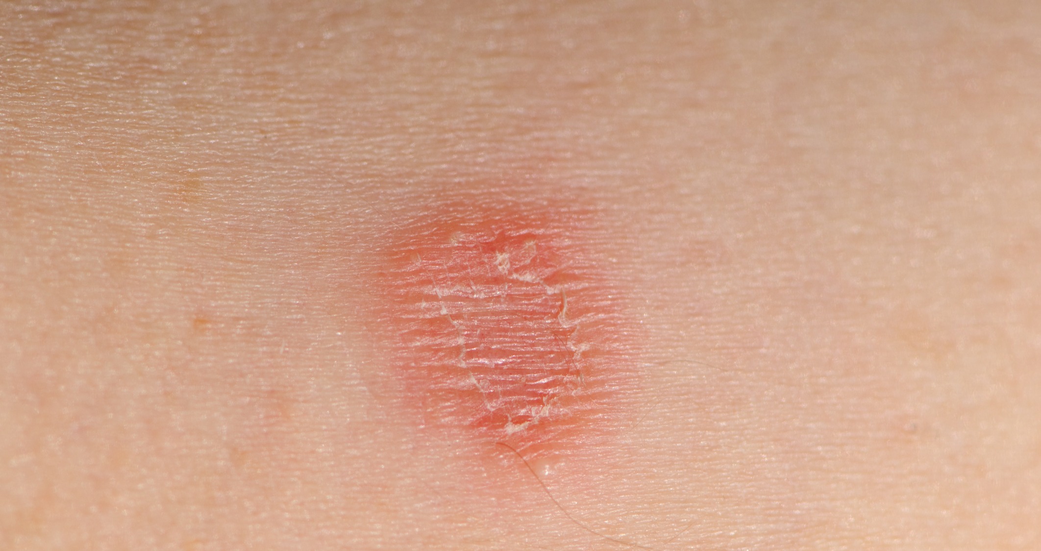 Ringworm can now be sexually transmitted | MDLinx