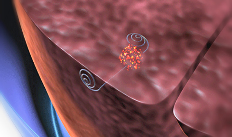 New way to target lung lesions avoids open chest surgery | MDLinx