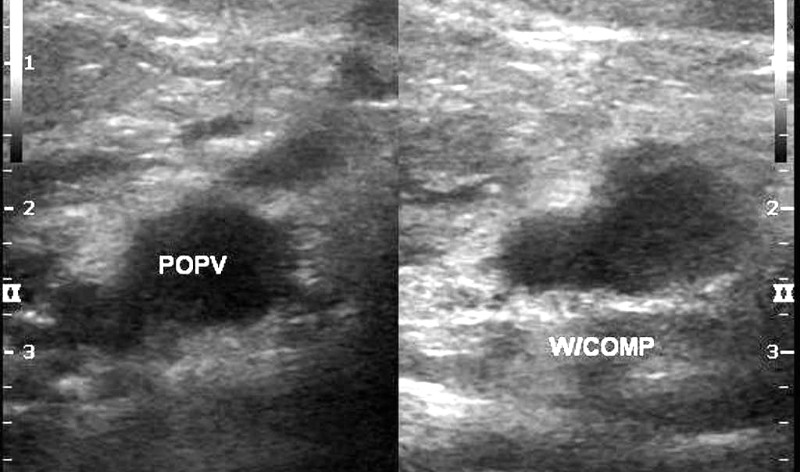 Trained PCPs diagnosed DVT as accurately as experts | MDLinx