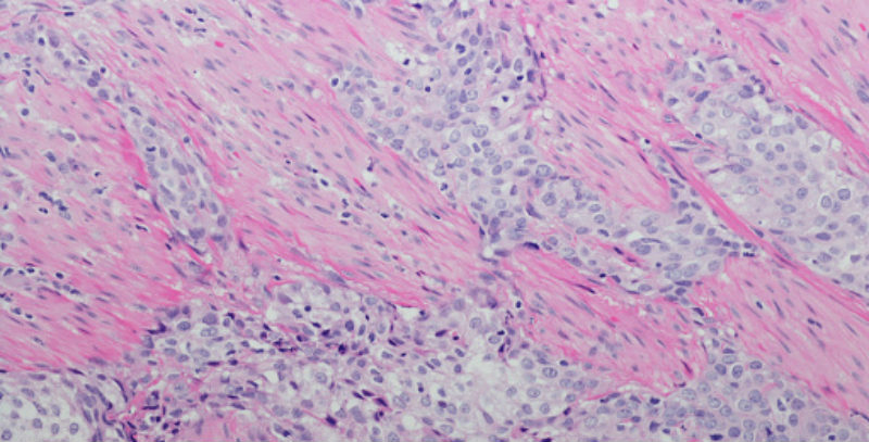 New urine test detects a biomarker of bladder cancer: A discussion with ...