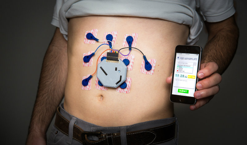 Wearable, noninvasive monitor continuously tracks GI activity | MDLinx