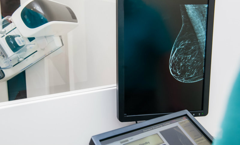 Clinical vs automated BI-RADS density measures | MDLinx