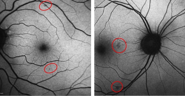 Quick retinal scan may spot Alzheimer's years before usual diagnosis ...