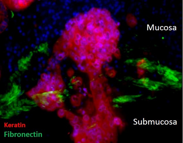 First-ever human colon model identifies six unknown cancer driver genes ...