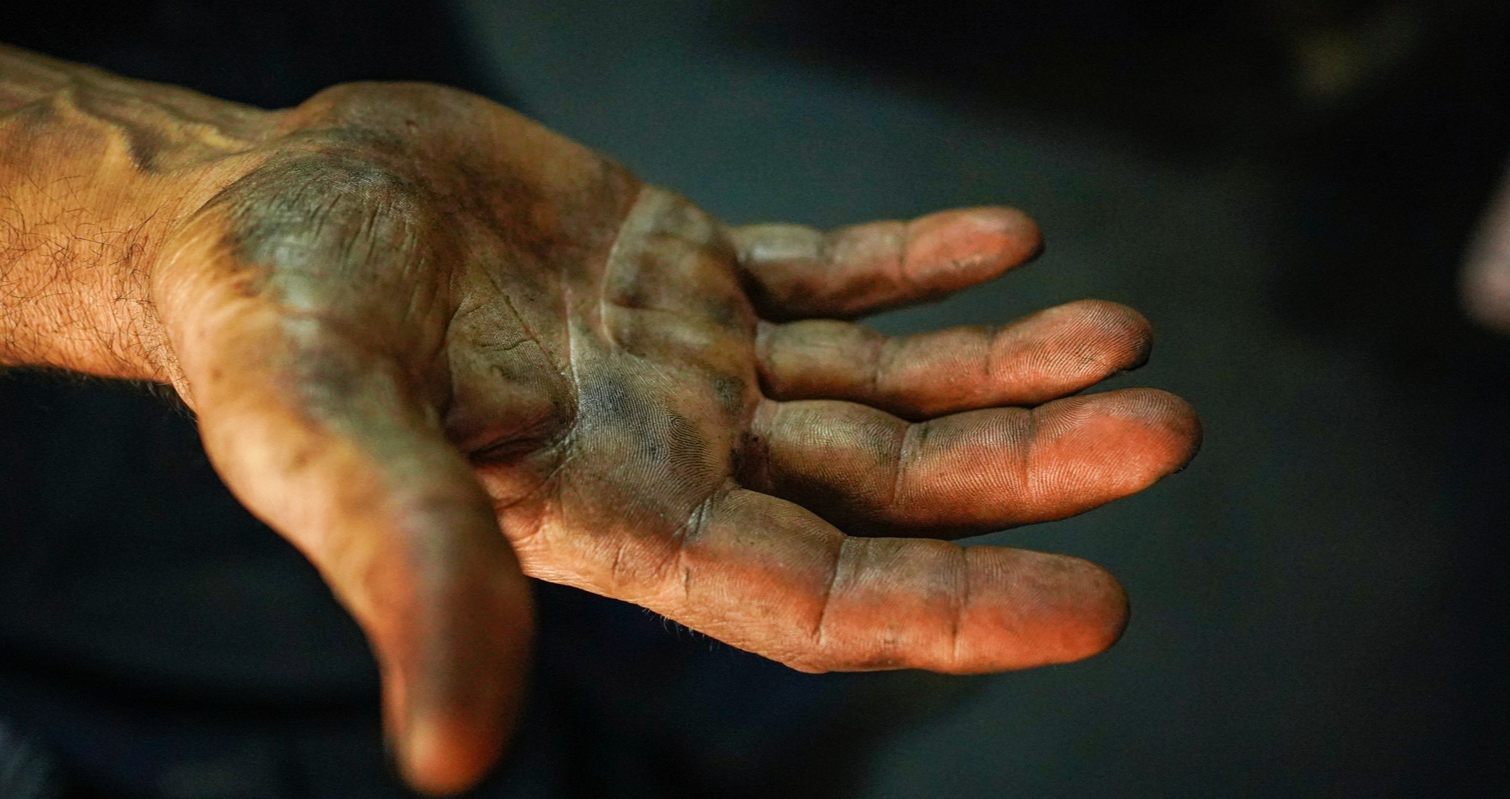 Pioneering surgery: Neurosurgeons redirect nerves from foot to enable ...