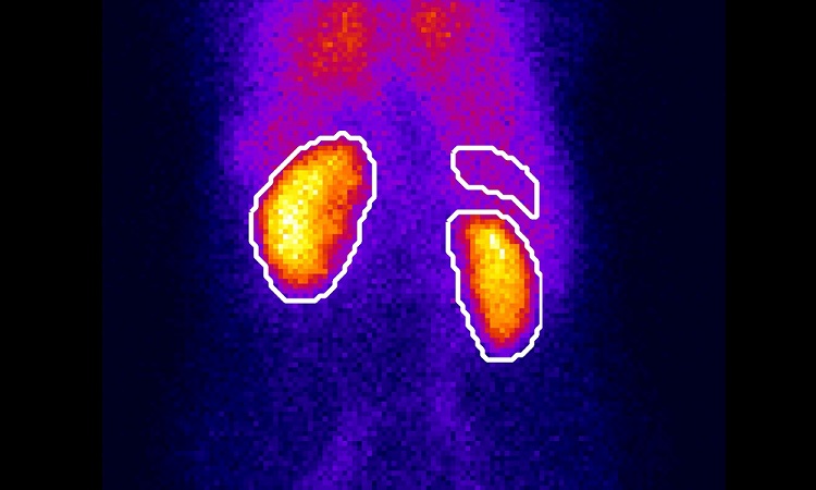 A new, easier method for determining split renal function | MDLinx
