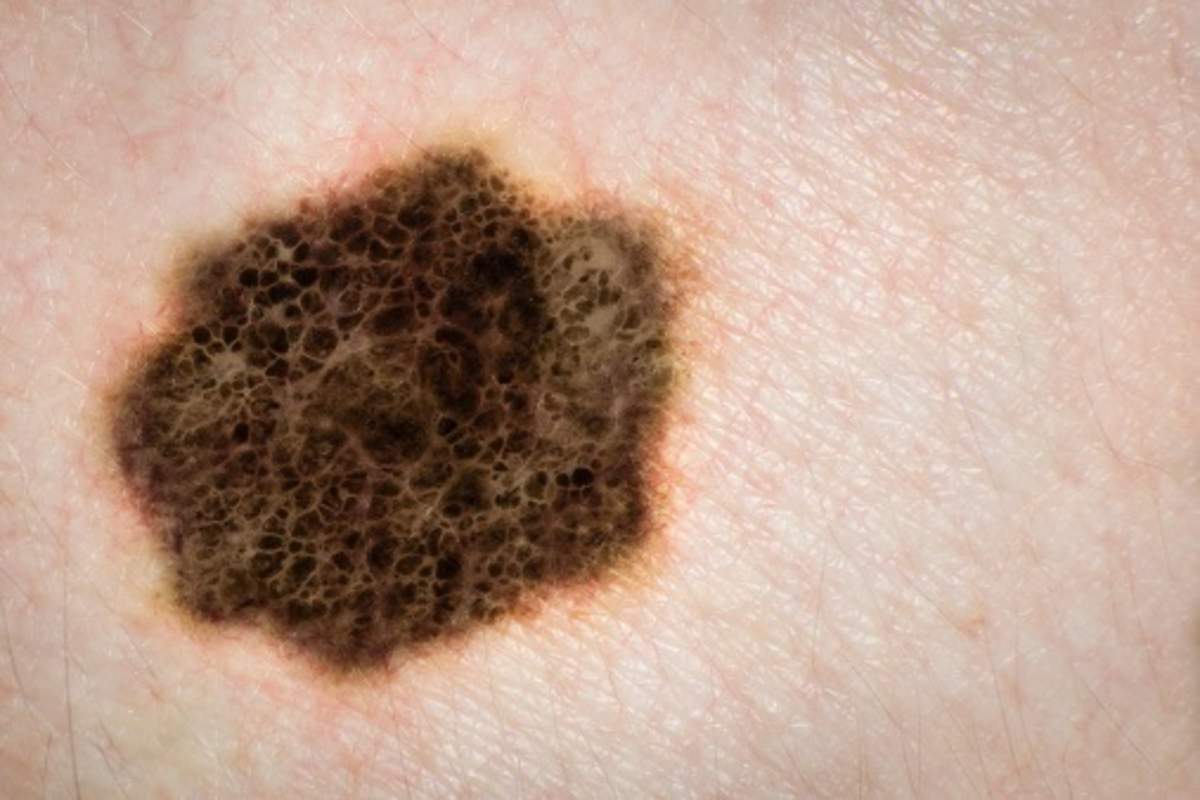 Mole Or Melanoma How To Tell The Difference mole-or-melanoma-how-to-tell-the-difference