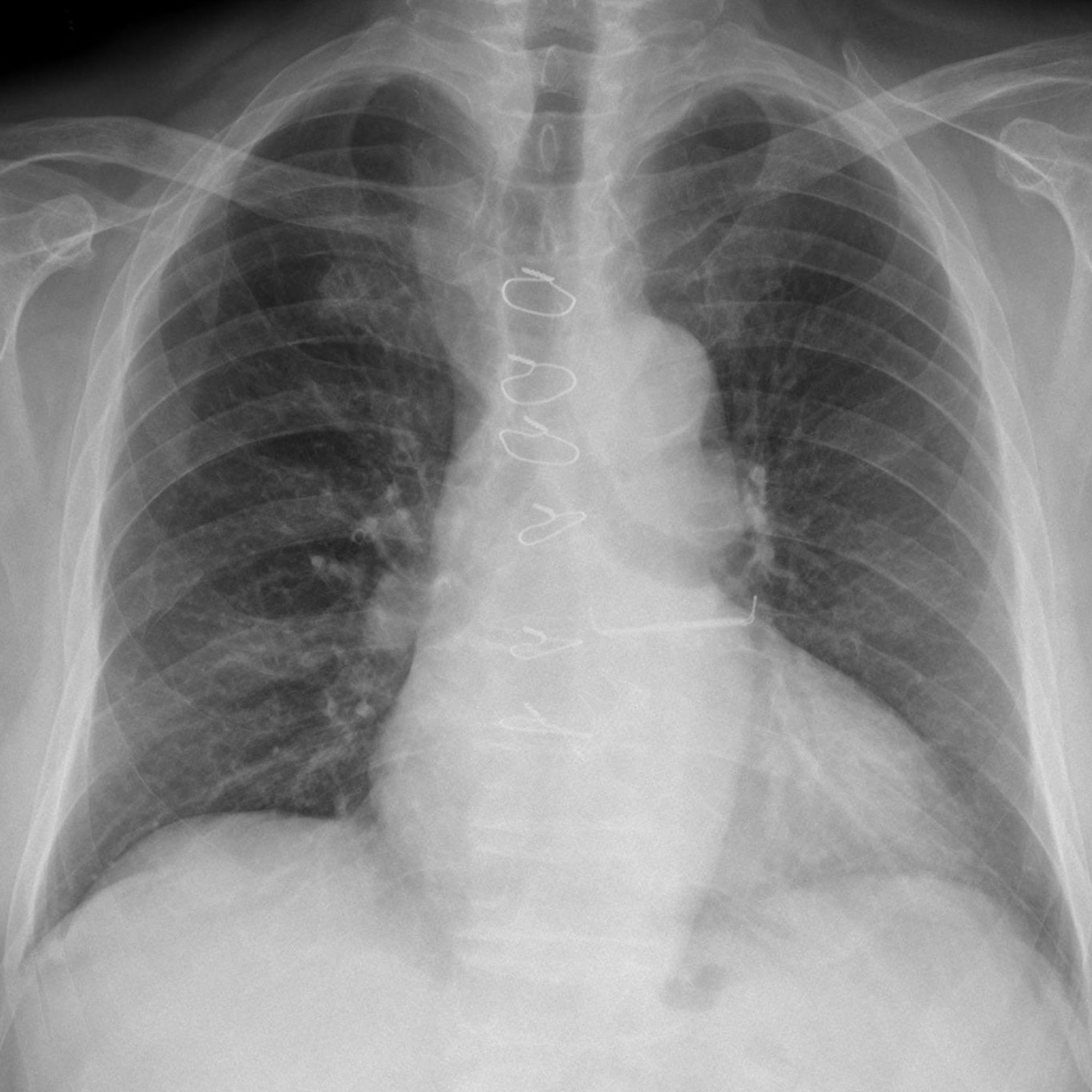 The Latest Thinking on Treating Afib