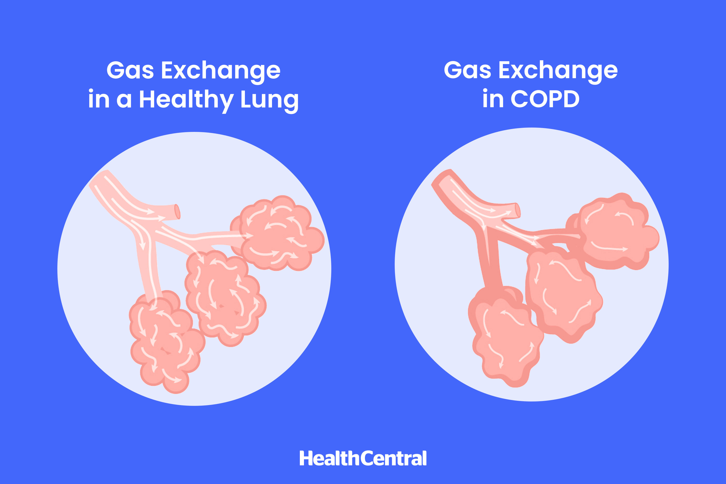 How COPD Affects Breathing: Visual Guide