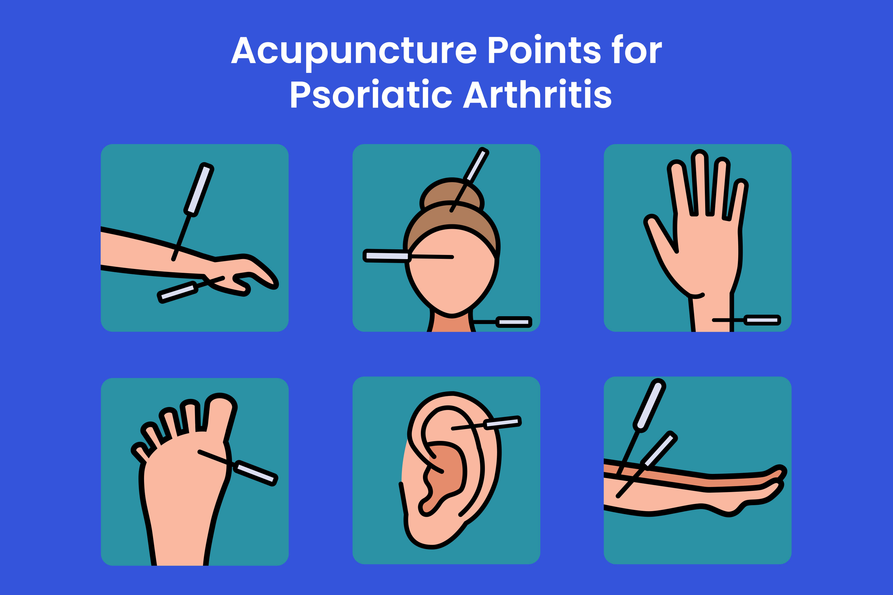 Acupuncture Points For Hand Arthritis