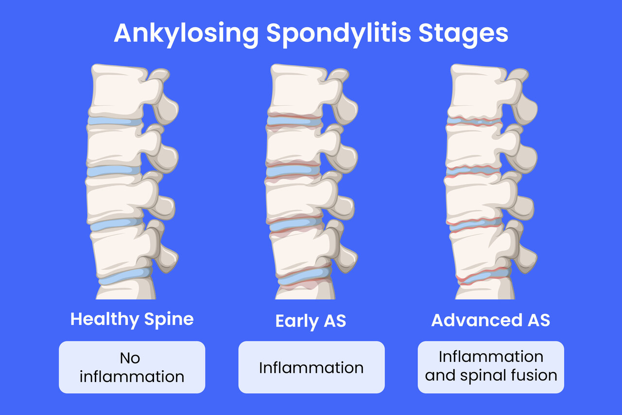 Ankylosing Spondylitis Patient
