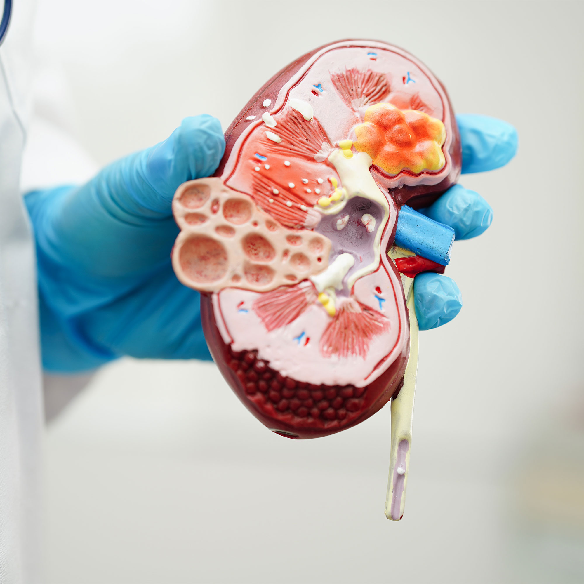 Rare Kidney Disease Complications