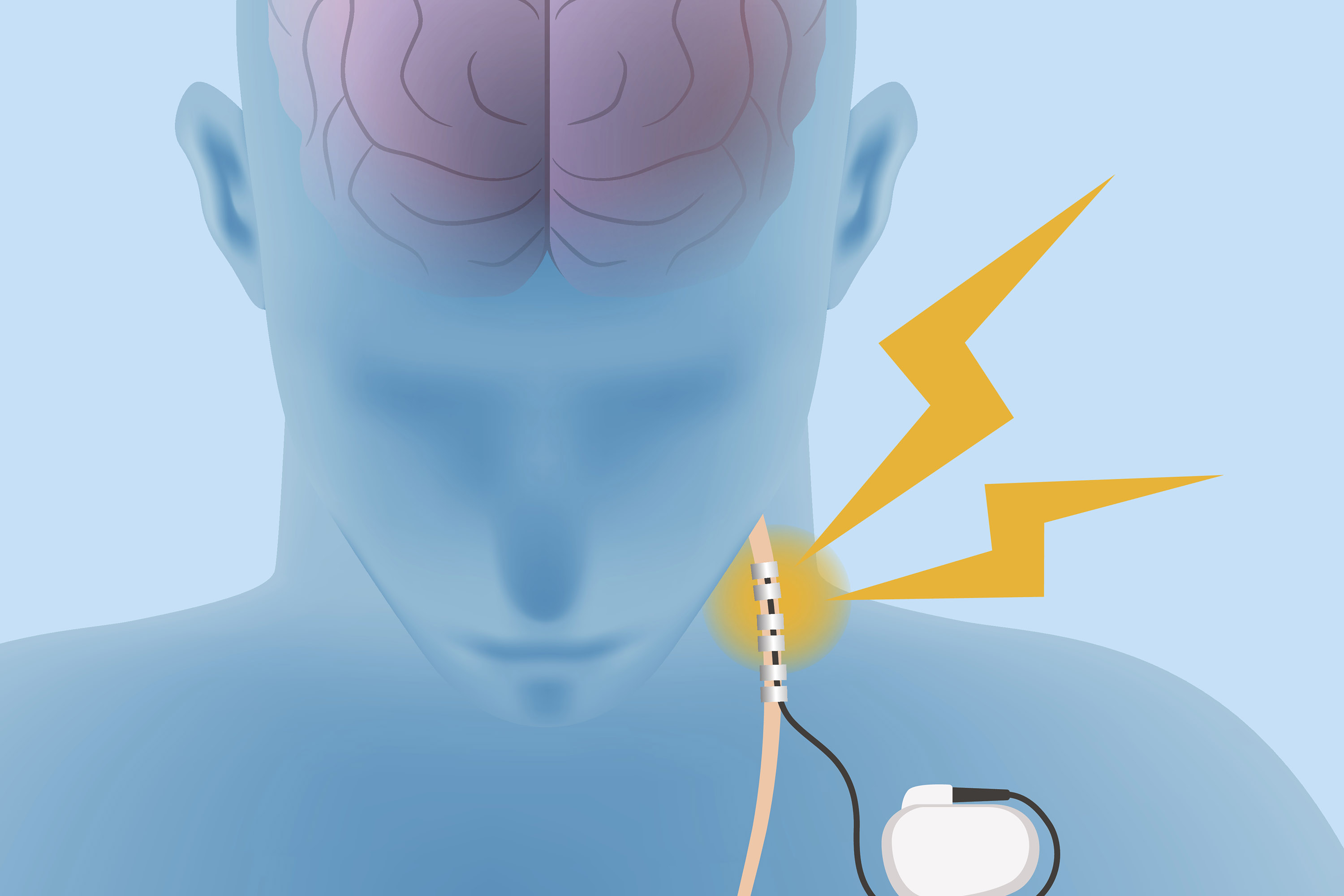 Could Nerve Stimulation Help Ease Your IBD Symptoms?