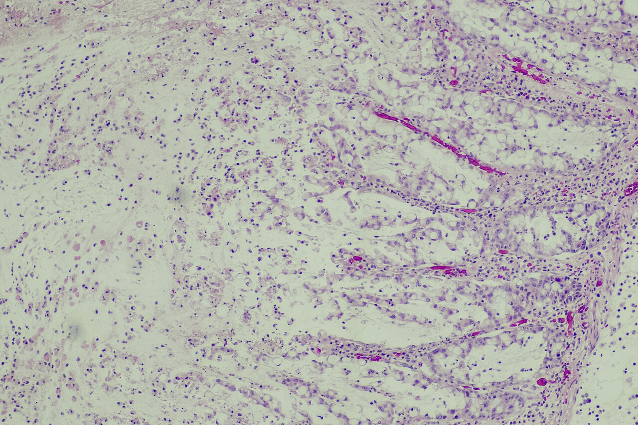 C Diff: Causes, Symptoms, and Treatment Options