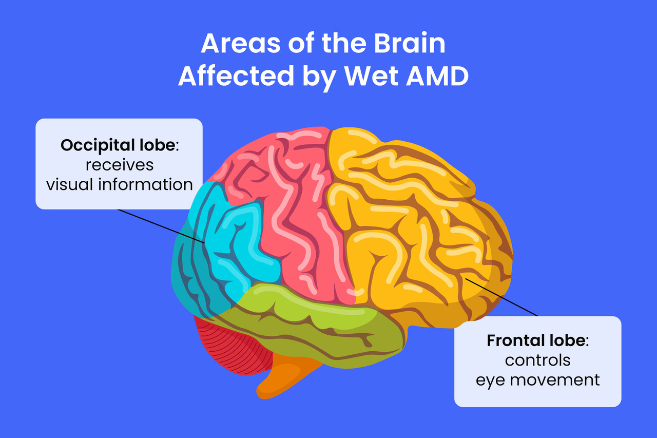 Wet Amd