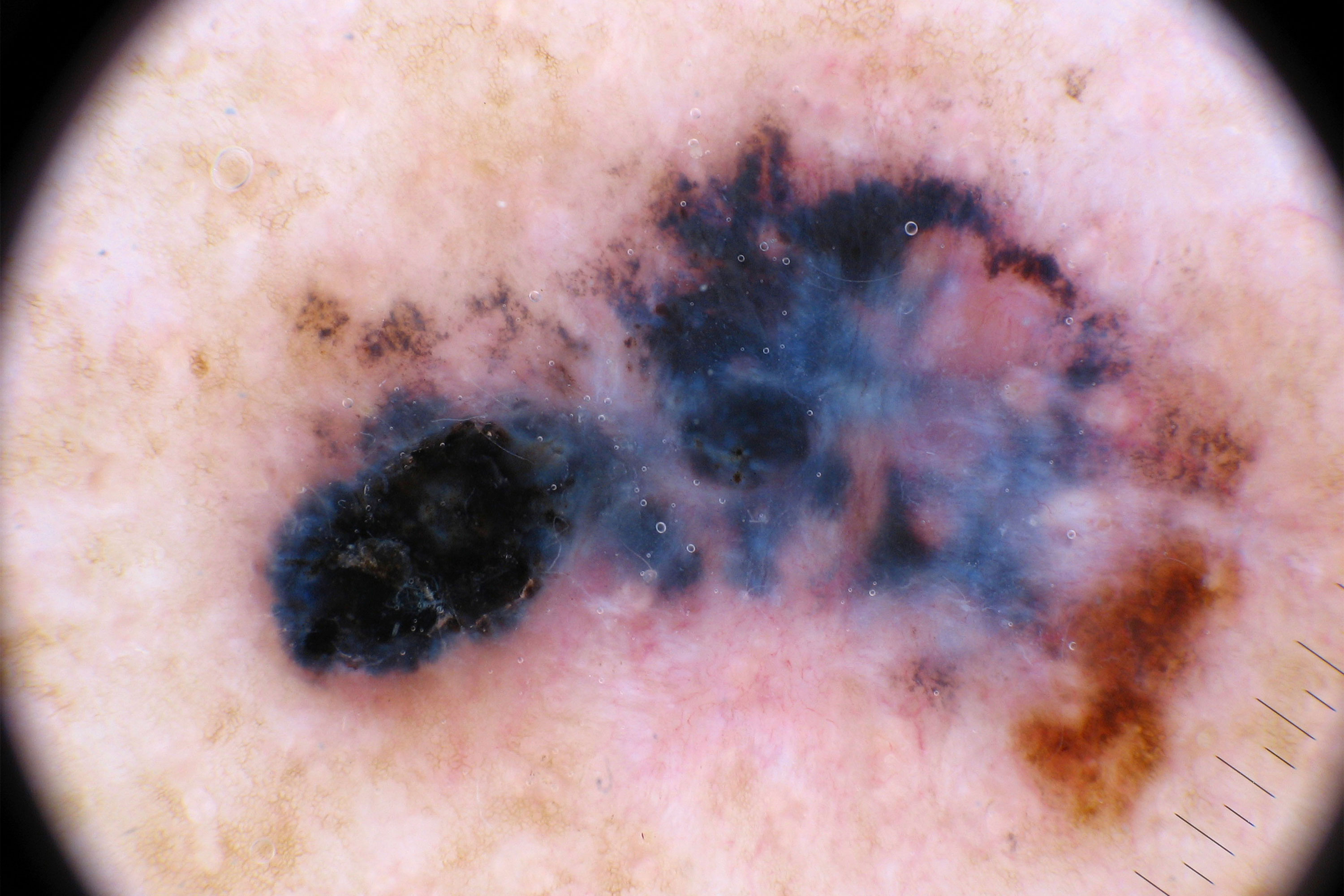 ABCDE's of Melanoma: What to Look For