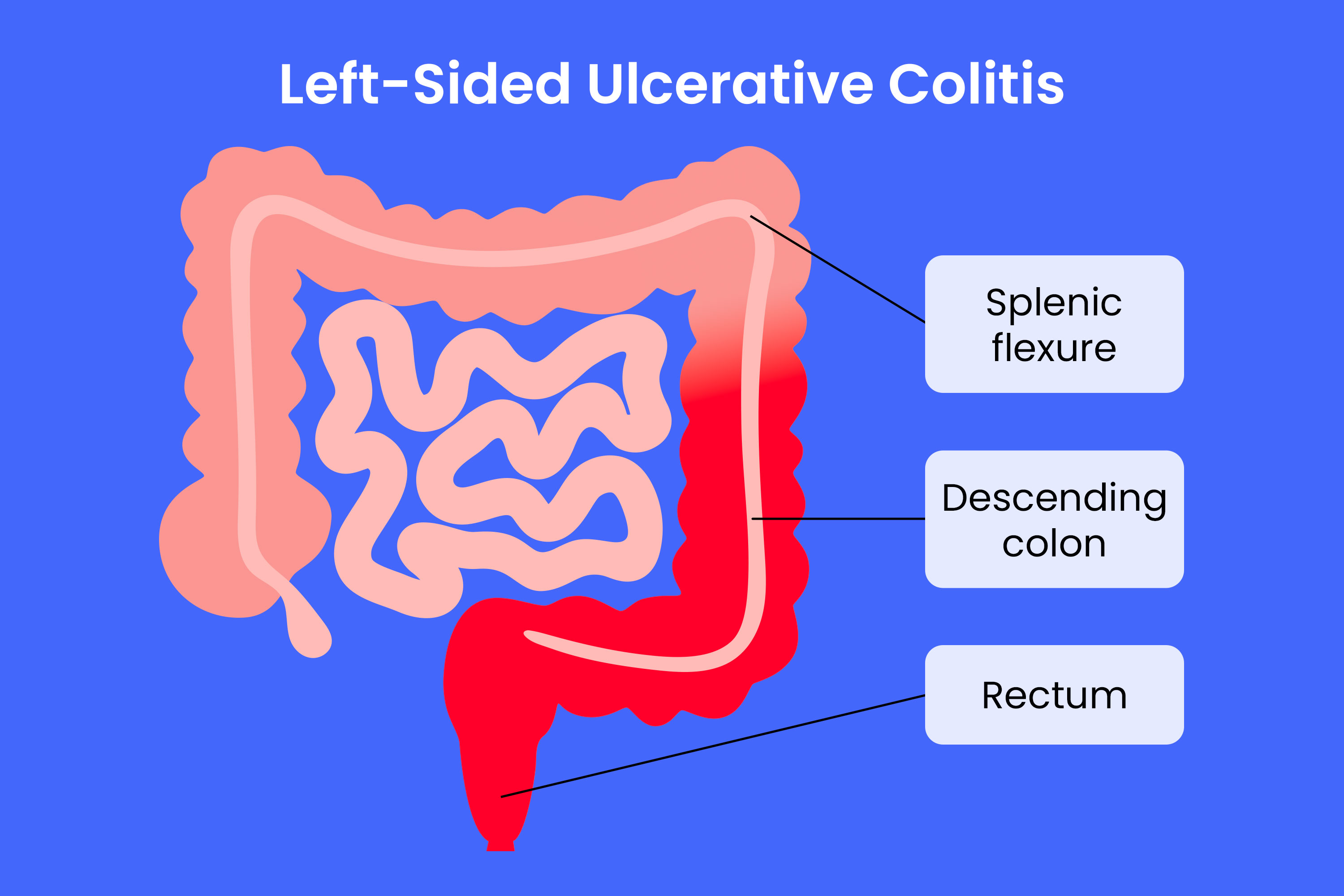 What to Know About Left-Sided Ulcerative Colitis