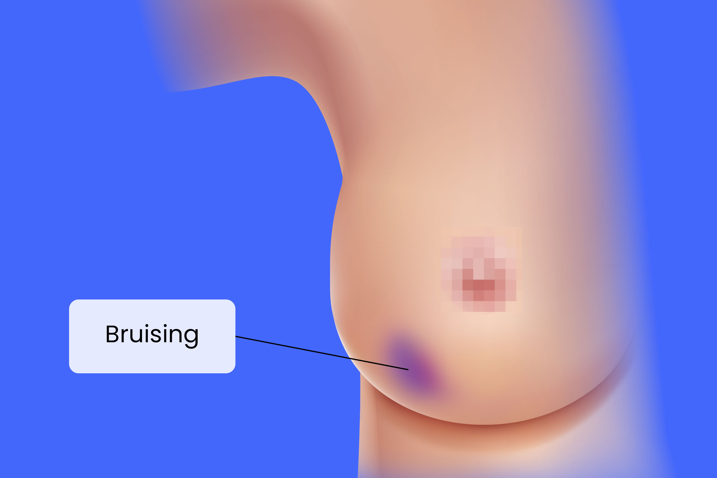 Pictures of Inflammatory Breast Cancer Rash: A Visual Guide